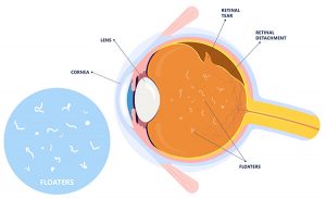 Eye Floaters Collingswood | Retinal Detachment Camden County